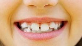 What causes crooked teeth? | Blog | Waterways Dental
